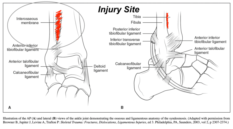 High Vs Low Ankle Sprains Whats The Difference